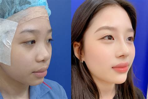Nâng Mũi Sụn Tai Có Vĩnh Viễn Không