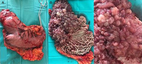 A Gastrectomy Specimen B And C Diffuse Infiltration With Polypoid Download Scientific