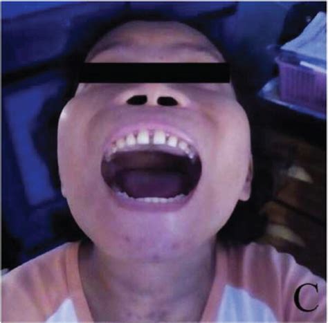Case 2 A Hard Palate Mass B Swelling In The Bilateral Maxilla And
