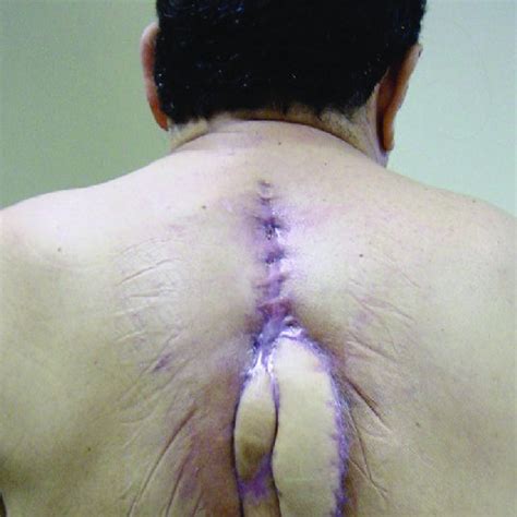 Partial Necrosis Of The Distal Tip Of The Flap With Consequent