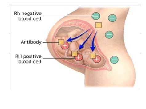 Rh Negative Pregnancy Or Rh Incompabilitypptx