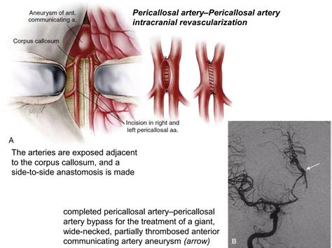 Intracranial Vascular Bypass Pptx