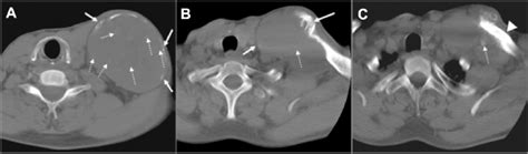 54 Year Old Male With Soft Tissue Tumor In Left Supraclavicular Fossa