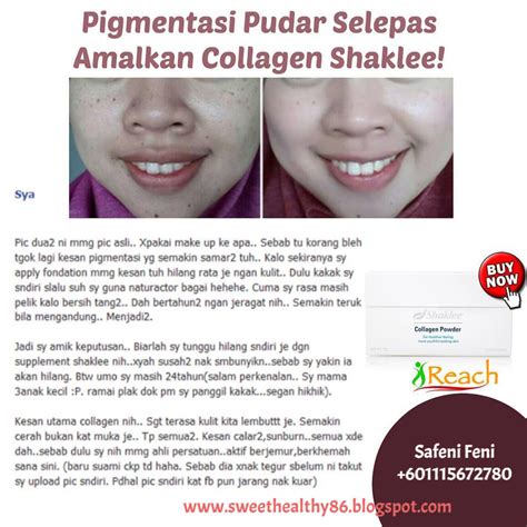 Kepentingan Vitamin C Dan Kolagen Untuk Kulit Blog Safeni Feni