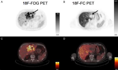 Intrahepatic Cholangiocarcinoma Demonstrating Heterogeneously Increased