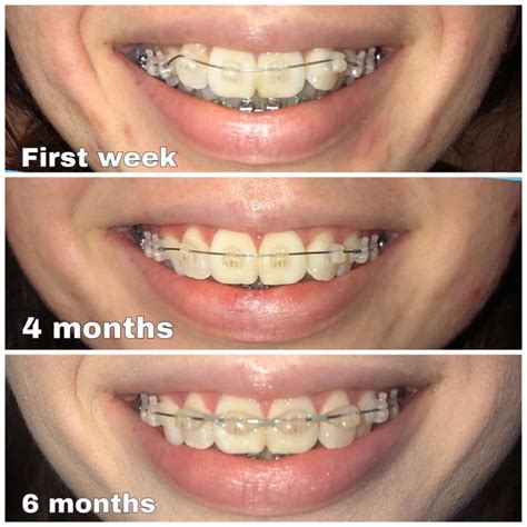 13 Month Adult Braces Progress Braces