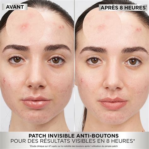 Patch Boutons Pure Active Soin Actif Anti Imperfections Garnier