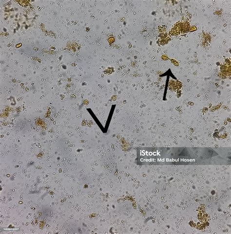 Microscopic Examination Of Stool Showing Blastocystis Hominis Parasite
