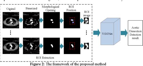 Figure 2 From Automatic Detection Of Aortic Dissection Based On