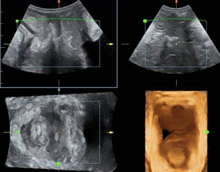 Rectovaginal Fistula After Fourth Degree Perineal Tear Transperineal