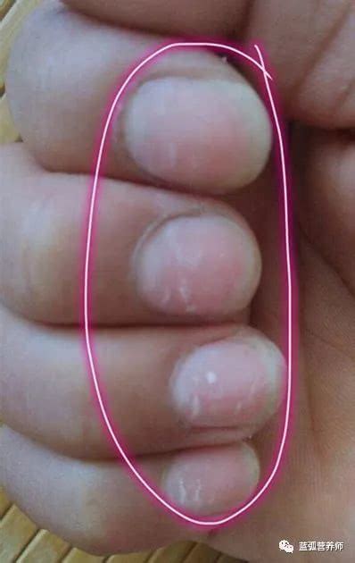 宝宝手指甲上白点图片宝宝缺钙手指甲图片宝宝缺锌指甲白斑图片第14页大山谷图库
