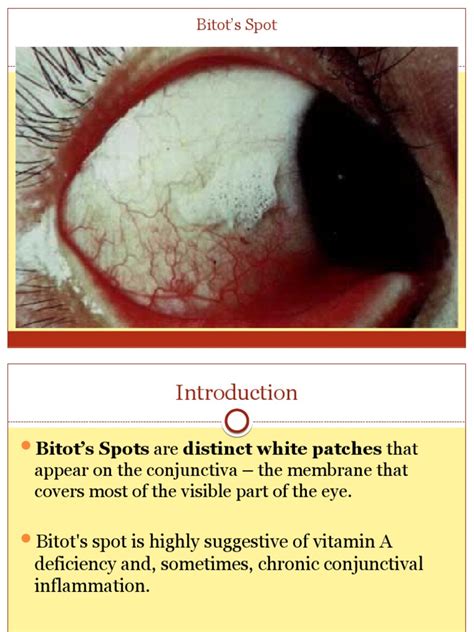 Bitots Spot Pdf Vitamin A Vitamin