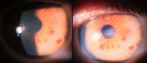 Stage 4 Diffuse Lamellar Keratitis After Laser In Situ Kerat