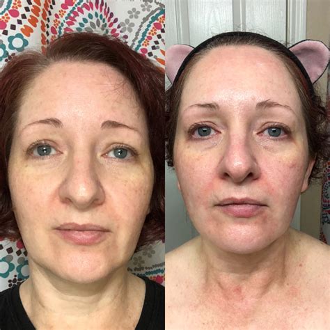 Update 2 Skin Experiment Using Differin For Wrinkles Wrinkles