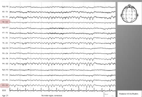 Benign Epileptiform Variants Of Doubtful Clinical Significance Eeg