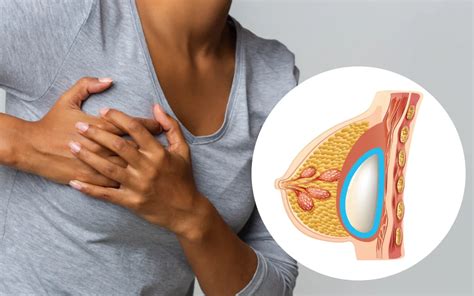 What Is Capsular Contracture Of Breast Implants