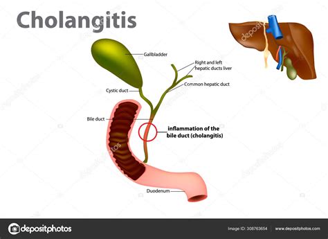 Cholangitis Ultrasound