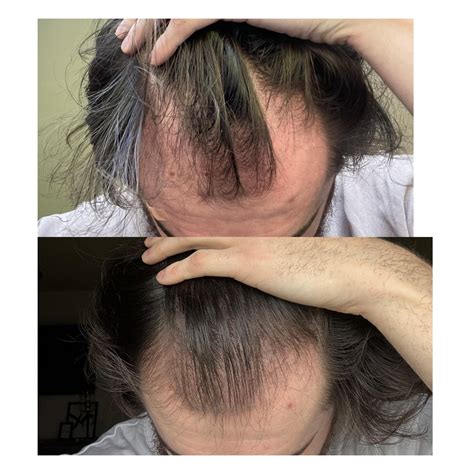 Diffuse Thinning Rhairtransplants