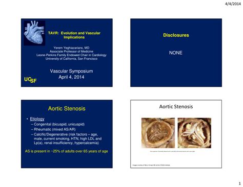 Ppt Aortic Stenosis Aortic Stenosis Etiology Congenital Bicuspid
