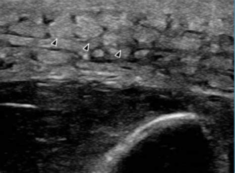 Pocus 4 Flashcards Quizlet