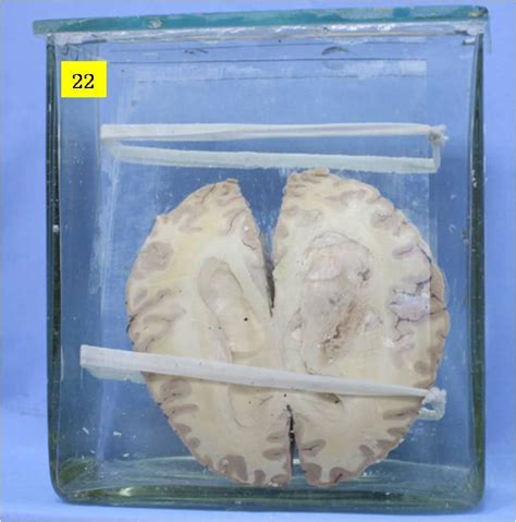 神经疾病 59 22 右侧基底节肿大，液化坏死 病理标本博物馆 复旦大学基础医学院