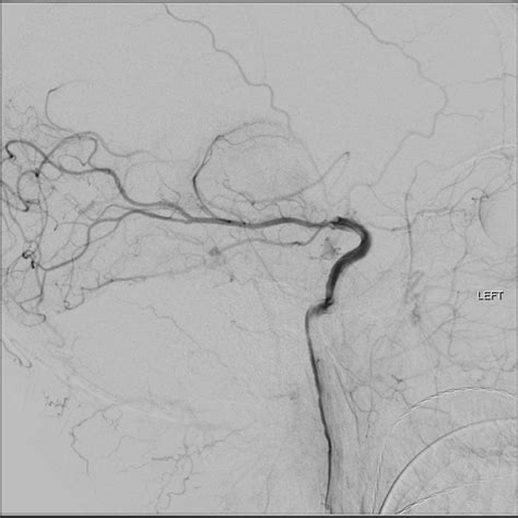 File Left Mca And Ica Occlusion Endovascular Clot Retrieval Radiopaedia Lateral