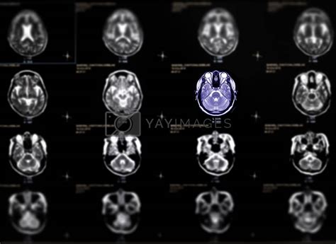 Selective Focus Of Mri Brain Axial View For Detect A Variety Of