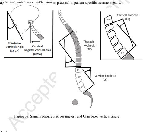 Sagittal Alignment Of The Spine What Do You Need To Know Semantic