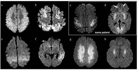 Radiological Findings In Hypoxic Ischaemic Encephalopathy Deranged Physiology