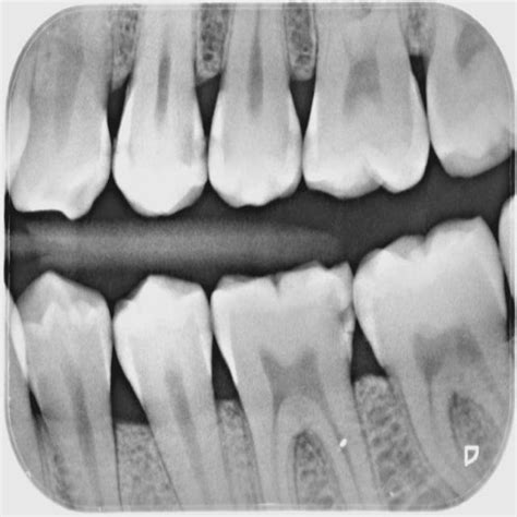 Caries Detection Instance Segmentation Dataset V3 2024 05 27 11 33am