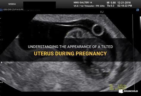 Understanding The Appearance Of A Tilted Uterus During Pregnancy