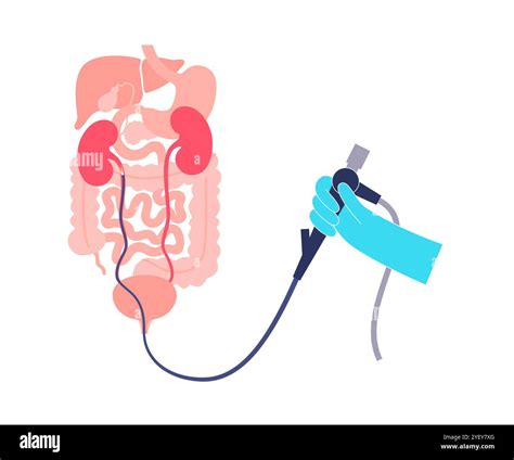 Conceptual Illustration Of A Ureteroscopy Procedure This Is A Procedure Performed To Examine Or