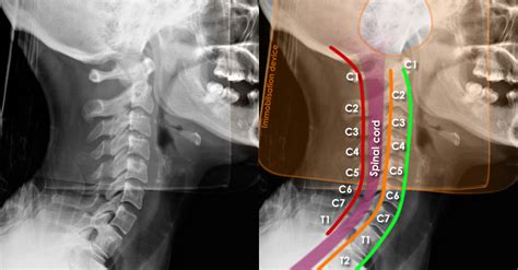 How To Read C Spine X Ray International Emergency 52 Off
