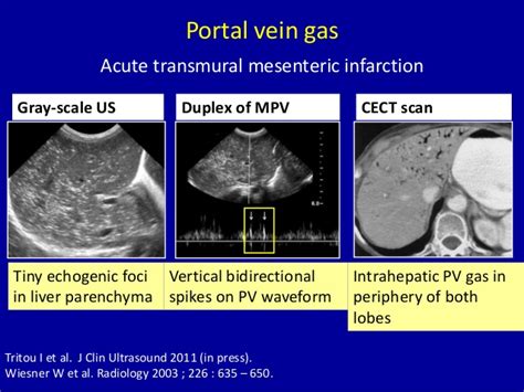 Tiny Echogenic Structure Passionfasr
