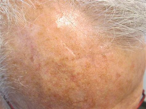 Mohs Micrographic Surgery Contour Dermatology