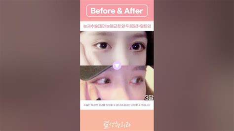 💗풀린눈 짝짝이눈 쌍수재수술💗 별성형외과 Youtube