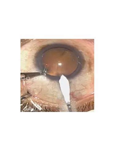 Micro Cataract Surgery In Pathanamthitta ID