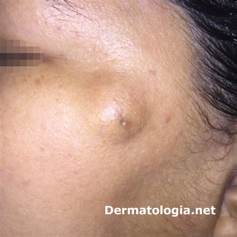 Cisto sebáceo precisa ser retirado Dermatologia netDermatologia net