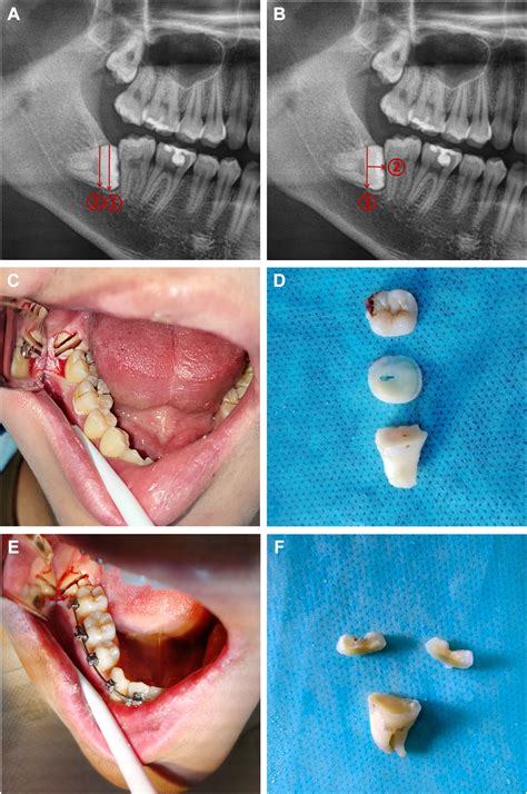 Removal Of Horizontally Impacted Mandibular Third Molars Using The