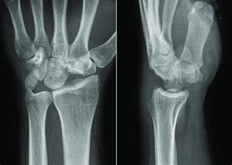 After Proximal Row Carpectomy The Shorter Radius Of Curvature Head Of