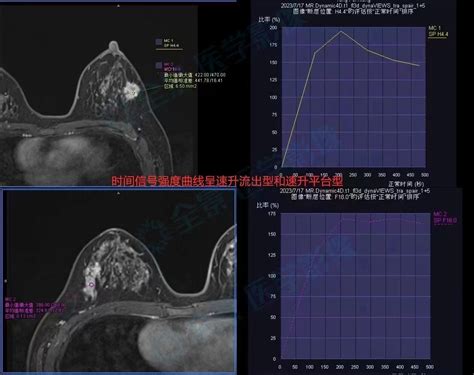 论乳腺磁共振动态增强检查重要性 乳腺磁共振 乳腺结节 磁共振 重要性 乳腺癌 淋巴结 乳腺 动态 增强 检查 钼靶 肿块 彩超 诊断 病变 健康界