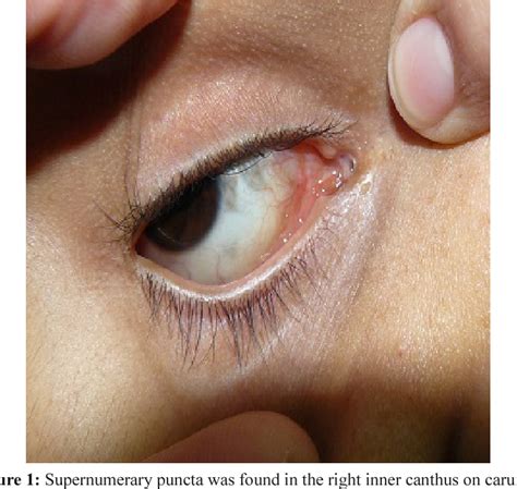Lacrimal Punctum