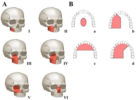 Browns Revised Classification Of Maxillary And Midfacial Defects 4
