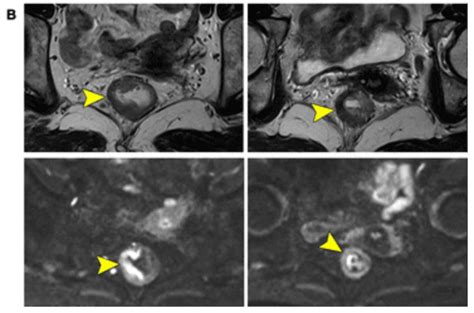 Diffusion Weighted Mri And Neoadjuvant Chemotherapy For Rectal Cancer What New Research Reveals