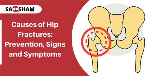 7 Causes Of Hip Fractures Prevention Signs And Symptoms Saqsham Ortho