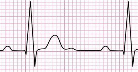 Ecg Interpretation