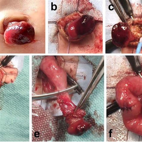 Resection Of A Patent Omphalomesenteric Duct Using An Intraumbilical Download Scientific