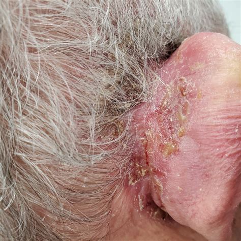 Retroauricular Eczema Algoritmd