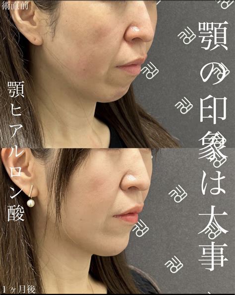 顎の印象は大事】顎ヒアルロン酸🫧1ヶ月後 Emmo Face Clinic