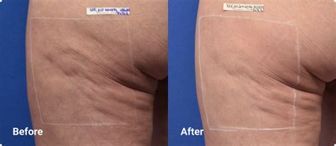 Sofwave Ultrasound Skin Tightening